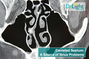 Deviated Septum: A Source of Sinus Problems